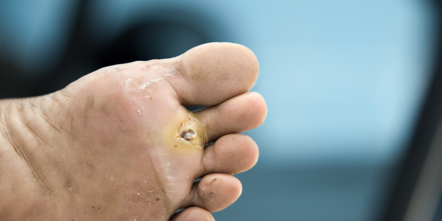 Four ways to treat and avoid getting a foot pressure ulcer | Stand Tall ...