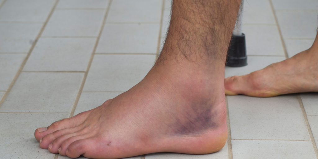 3 Signs That You Should See a Doctor About a Sprained Foot | Stand Tall ...